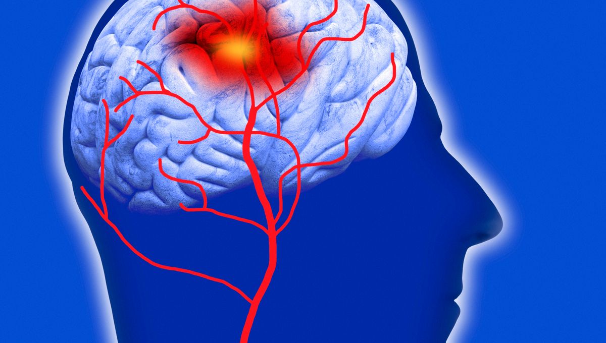 Comment dépister et prendre en charge un AVC?